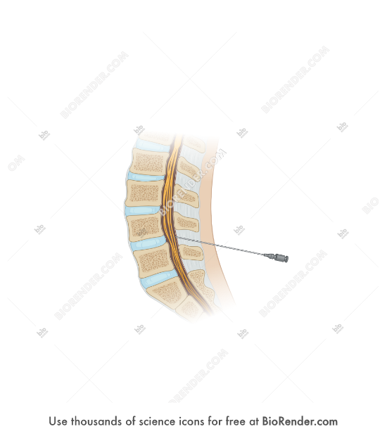 BioRender | Lumbar puncture