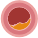 Free Atherosclerosis (cross-section, 1c. fibrous plaque) Icons, Symbols ...