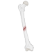 Free Femur (anterior, fracture) Icons, Symbols & Images | BioRender